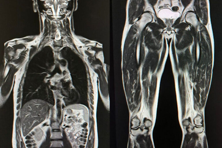 The key to accurate and reliable full-body MRI - Visio Magneettikuvaus